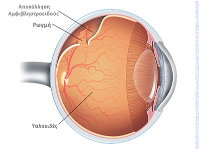Αποκόλληση Αμφιβληστροειδούς – e-farmacy | eye